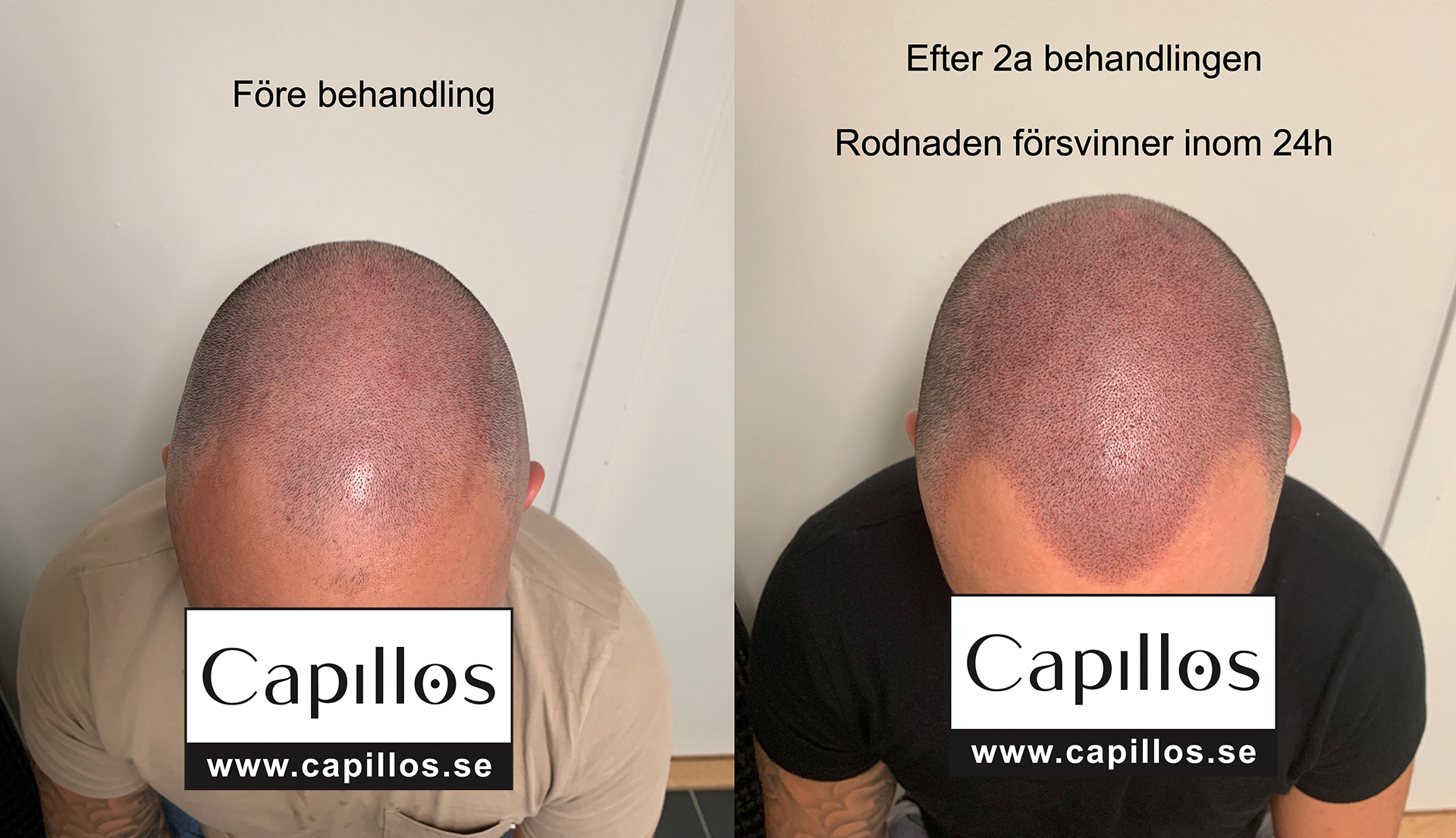 Tappar hår? Scalp micropigmentation kan vara lösningen - SMP